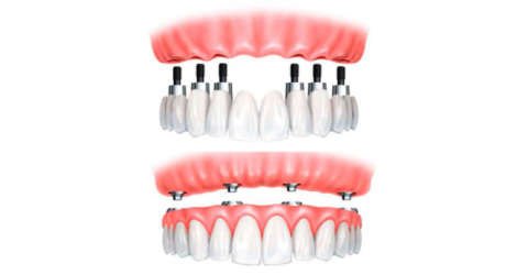 O que é uma prótese do tipo Protocolo? - Dentista em Porto Alegre ...